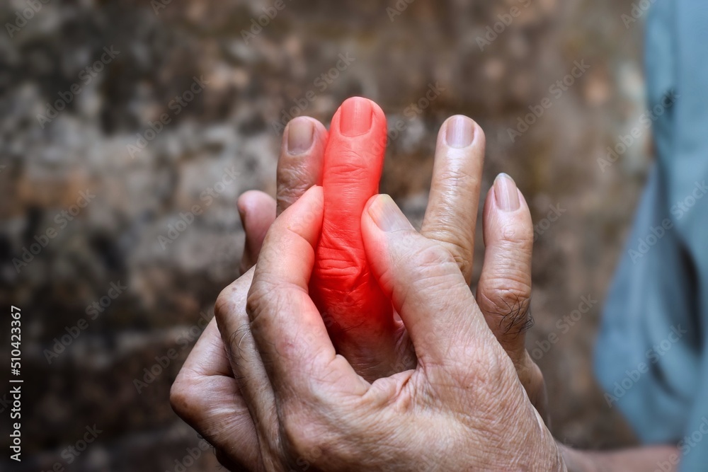 Inflammation of Asian man middle finger and hand. Concept of cellulitis ...