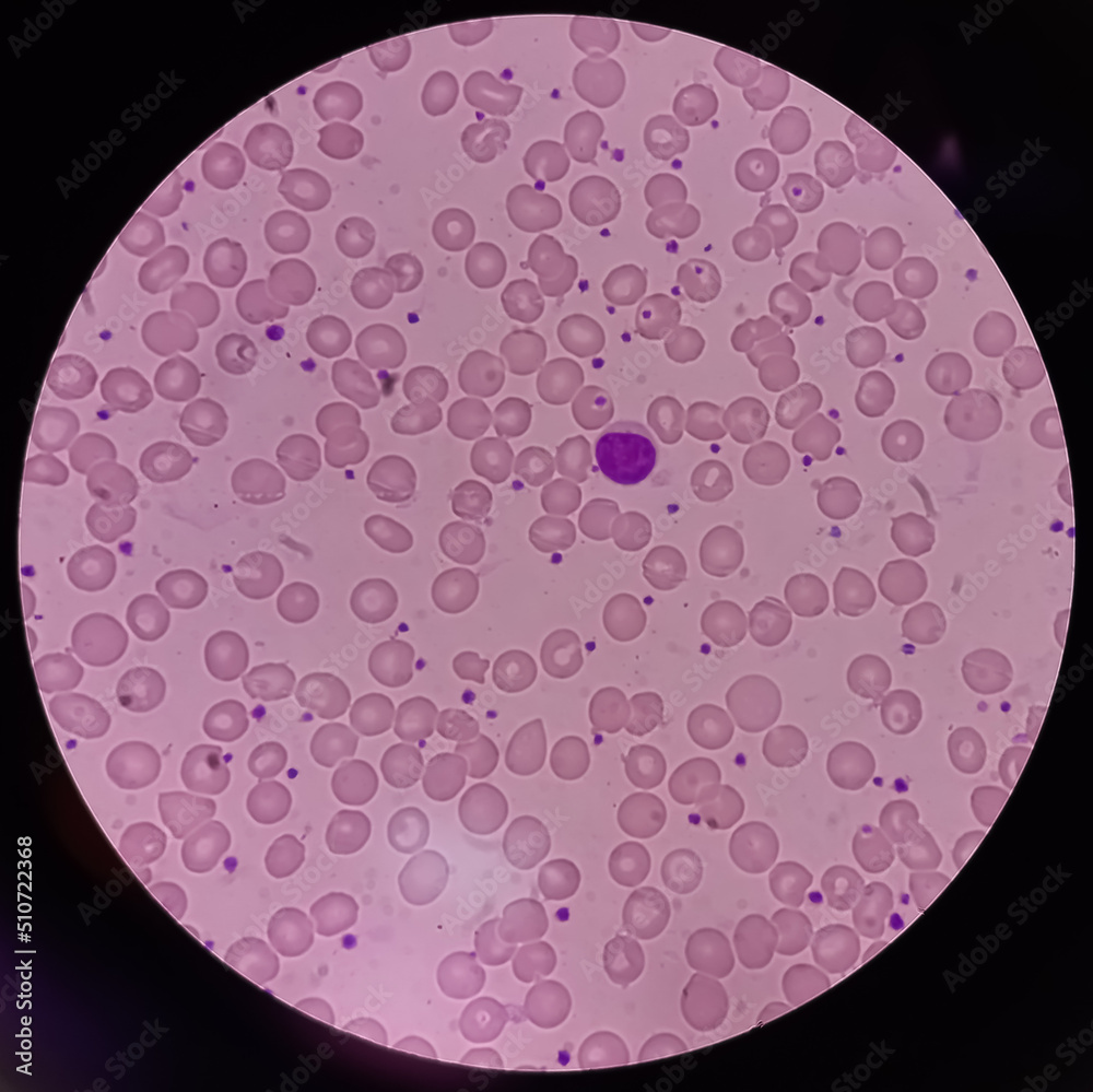 Thrombocythemia with leukocytosis, Essential thrombocytosis blood smear ...