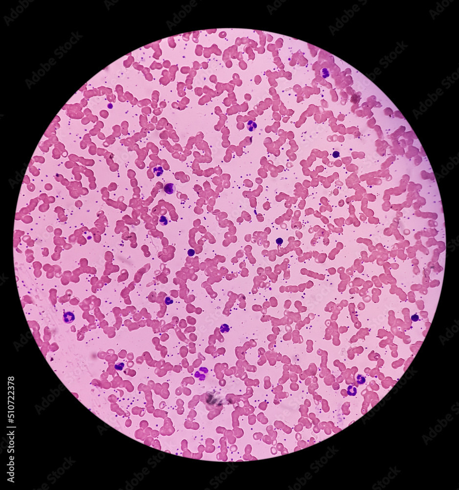 Thrombocythemia with leukocytosis, Essential thrombocytosis blood smear ...