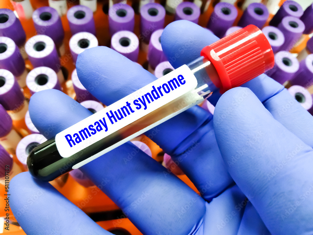 Ramsay Hunt syndrome blood sample test at medical laboratory. Which is ...