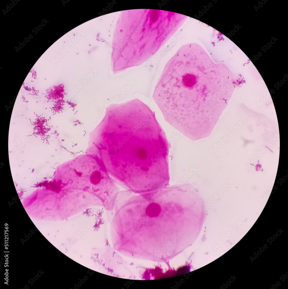 Prostatic Smear (PS) gram stain microscopic 40x show epithelial cells ...