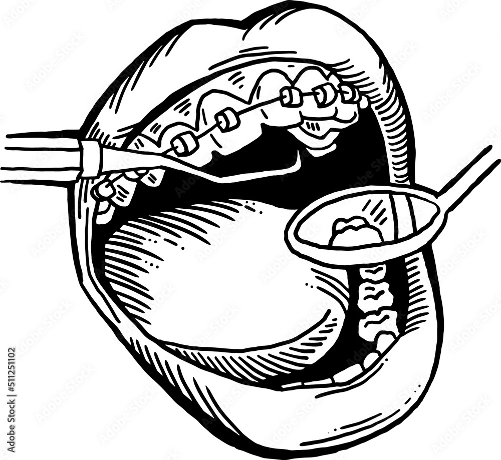 Braces on the teeth. Medical dentist checkup in dental clinic. Tooth ...