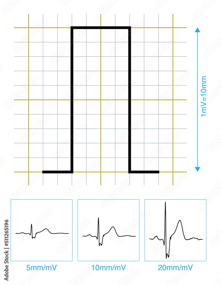 When 1mV voltage is input to different ECG calibration voltage, the ...