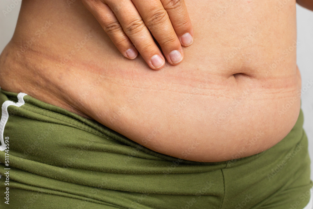 Cropped overweight and fat female belly touching naked excessive ...