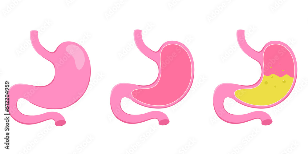 Healthy and unhealthy, empty and full human stomach. Digestive system ...