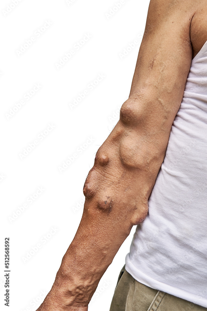 Arteriovenous fistula in the right forearm of hemodialysis patient ...