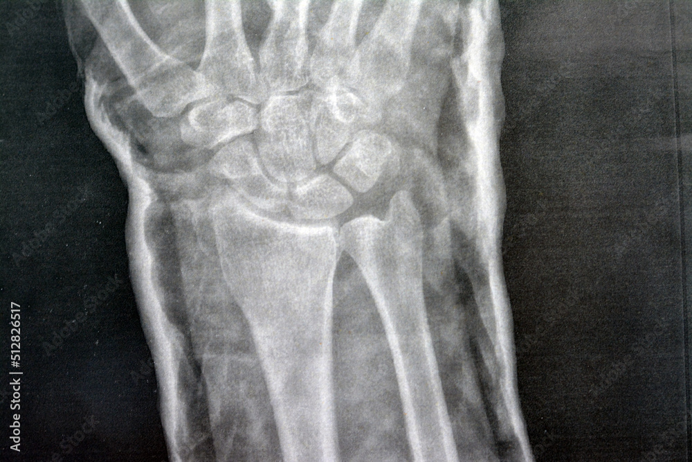 Plain x ray right wrist joint shows right distal radius fracture ...
