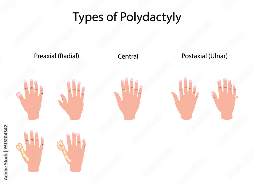 illustration of biology and medical, Types of polydactyly, Symptoms of ...