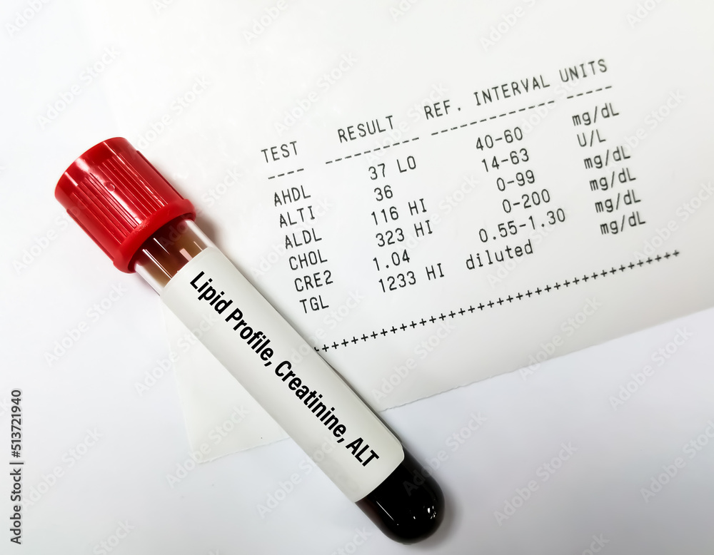 Blood sample isolated for Lipid Profile, ALT, Creatinine test with ...