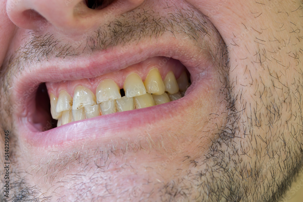 Teeth with plaque and caries of a man. Stock Photo | Adobe Stock