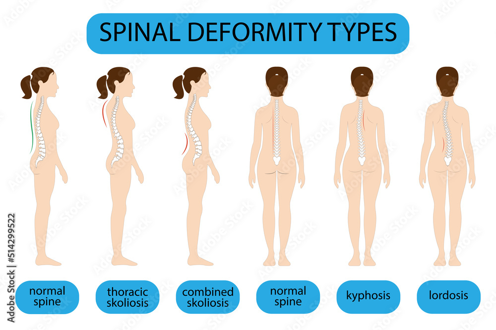 Spine deformation types and healthy spine comparison diagram poster ...