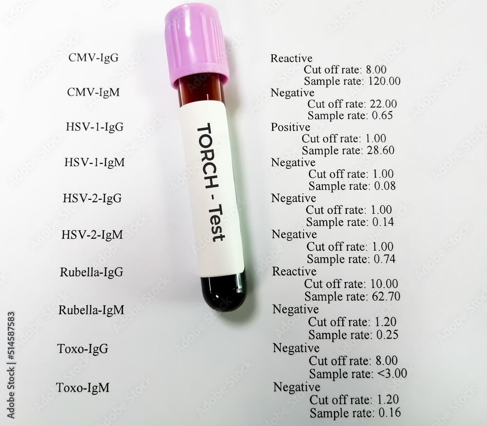 Blood sample for TORCH test, TORCH Panel Test.Toxoplasma, Rubella ...