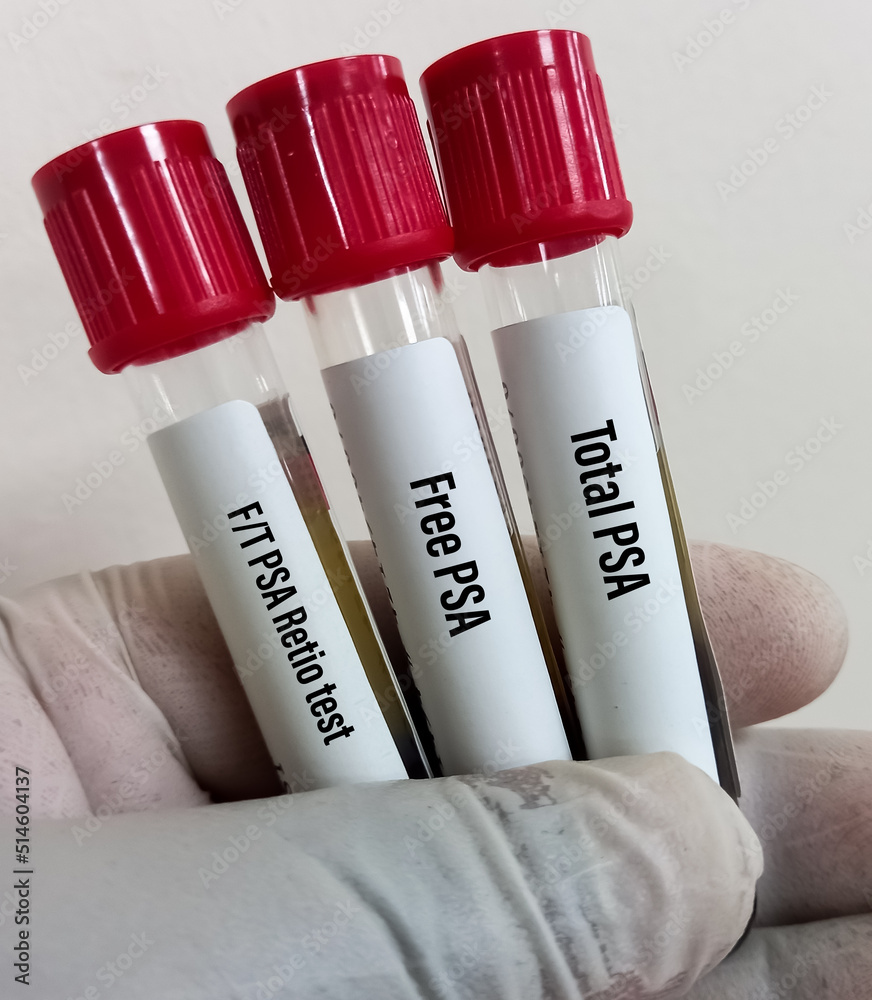 Blood test sample for PSA (Total,Free and Retio) test. Prostate ...