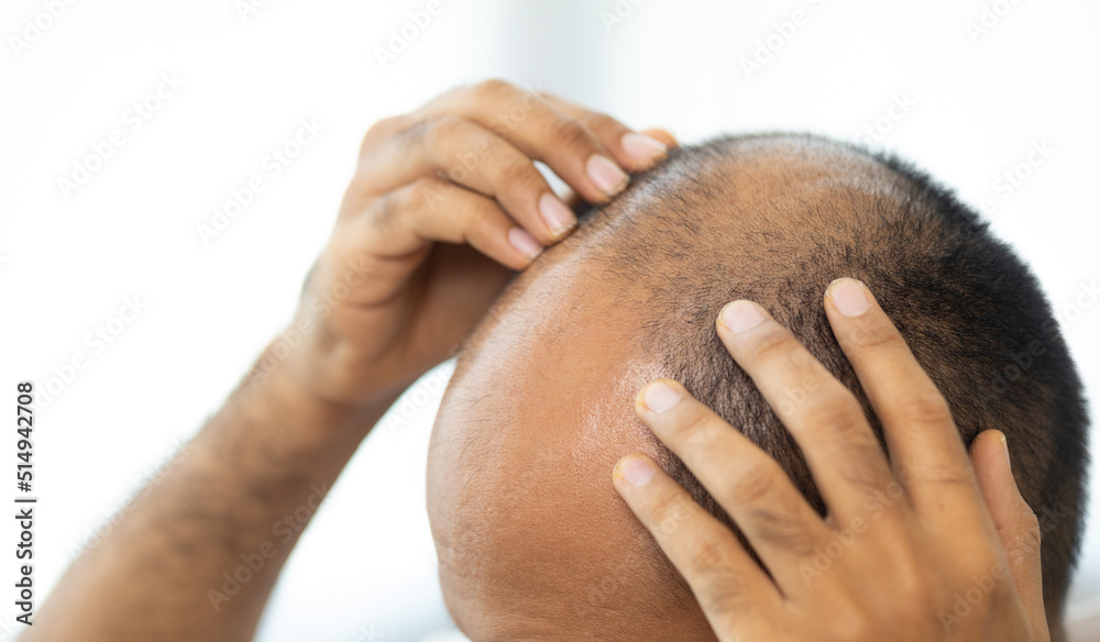Stockfoto Close up man hair loss. Young man itchy head There is a ...