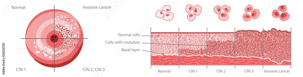 Set of Cervical cancer Dysplasia stages infographic Female reproductive ...