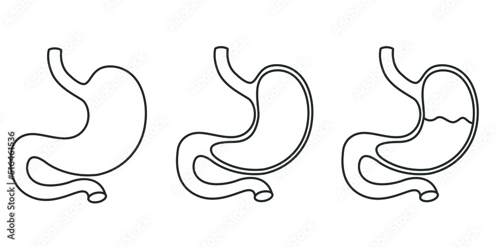 Healthy and unhealthy, empty and full human stomach. Digestive system ...