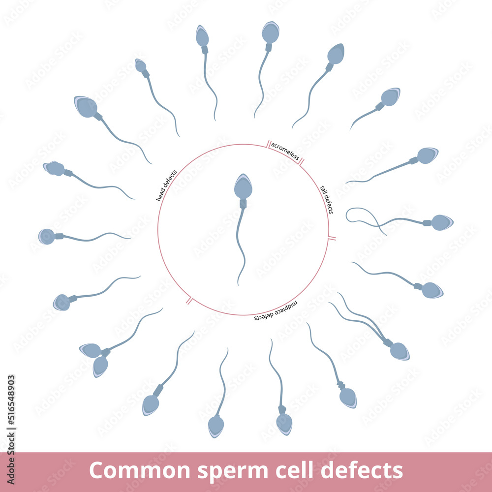 Common sperm cell defects. Visualization of common sperm cell defects ...