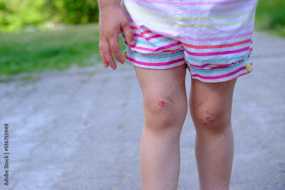 fresh wound, bleeding abrasion on knees of girl child fell on walk ...