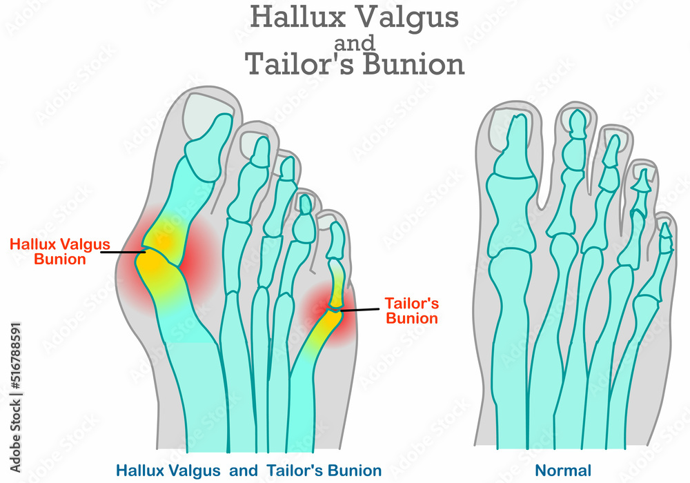 Tailor 's Bunion, hallux valgus anatomy. Foot bones, joint deformity ...