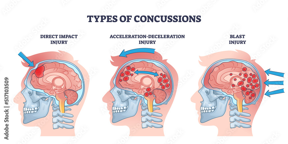 Concussion and head trauma or injury types from medical view outline ...