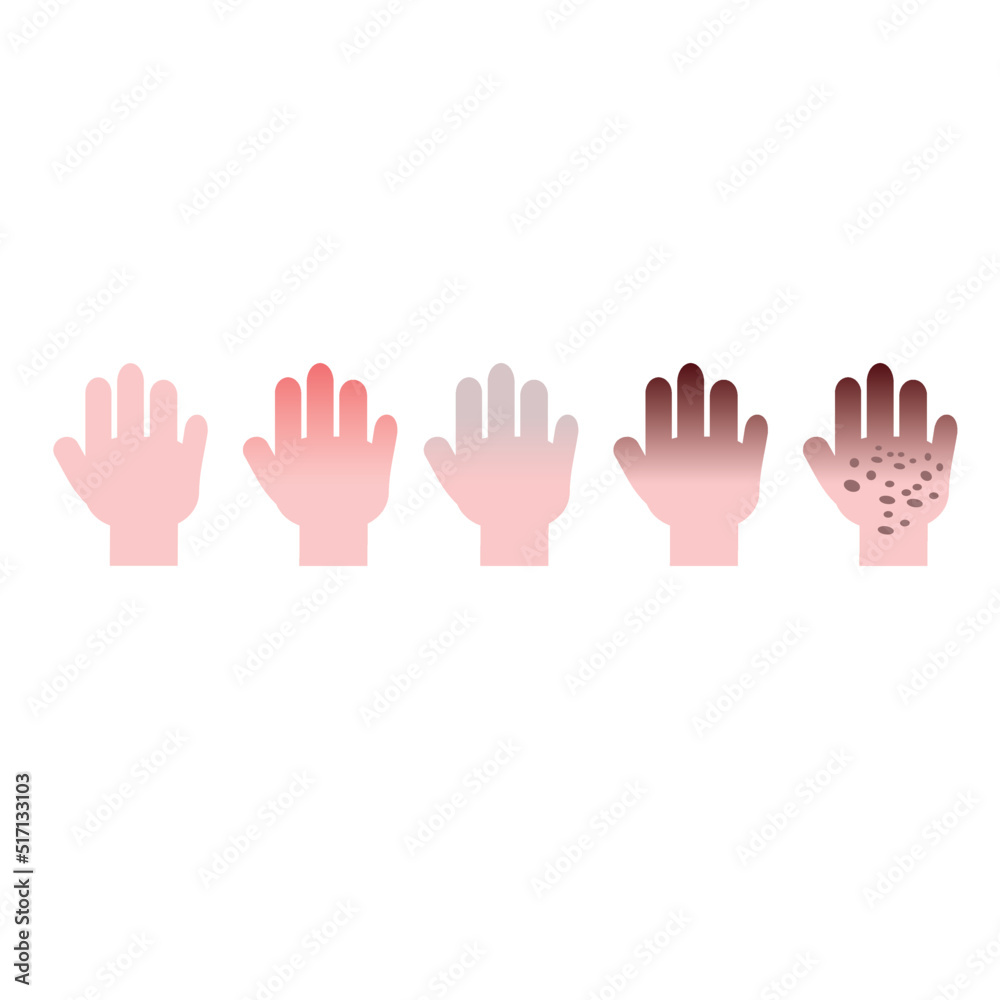 Stage of frostbite.Hypothermia symptom.Frozen hands with fingers.Skin ...