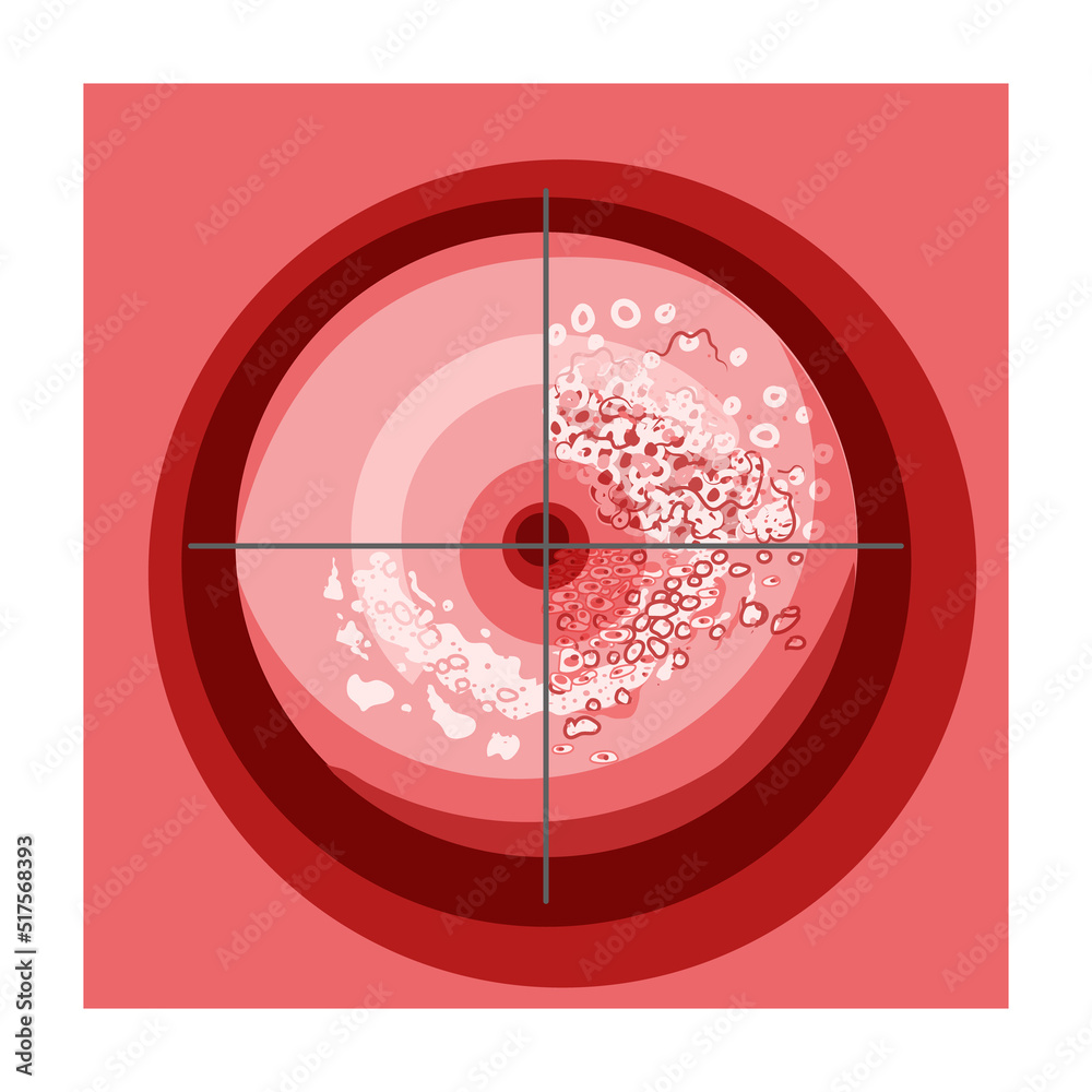 Cervical invasive cancer Dysplasia 1 2,3 and normal stage infographic ...