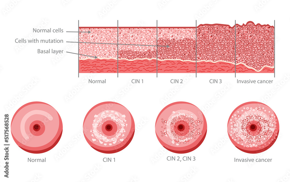 Stock-Vektorgrafik „Cervical invasive cancer intraepithelial neoplasia ...