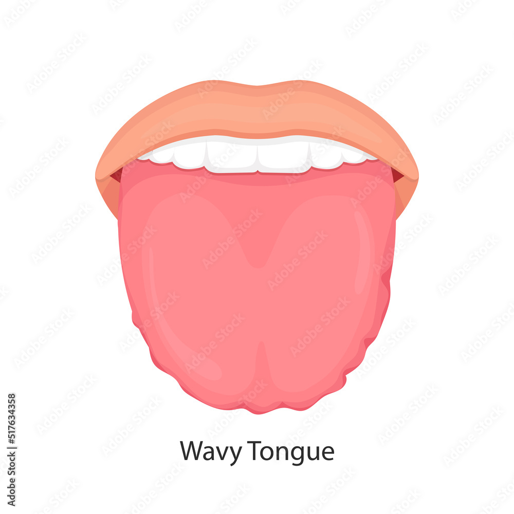White Bumps On Tongue Lie Bumps
