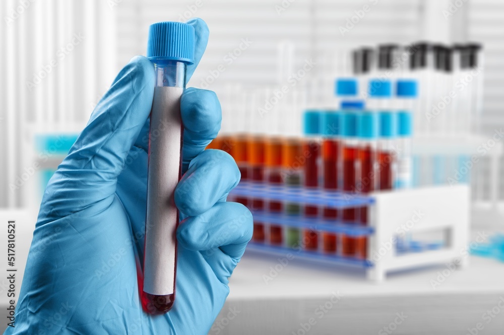 Blood sample tube for virus test. It is also known as the Moneypox ...