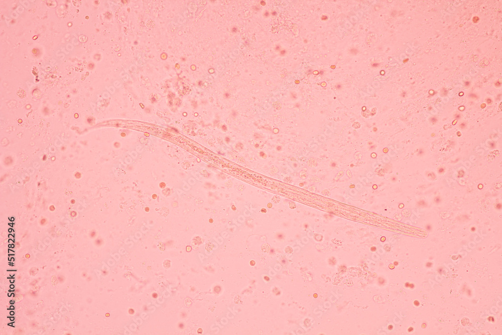 View in microscopic Strongyloides stercoralis or threadworm in human ...