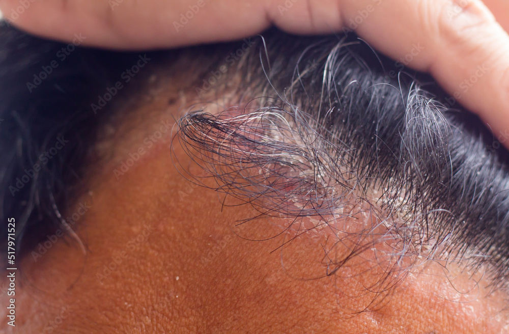 skin disease at the head, Dandruff is a common condition that causes ...