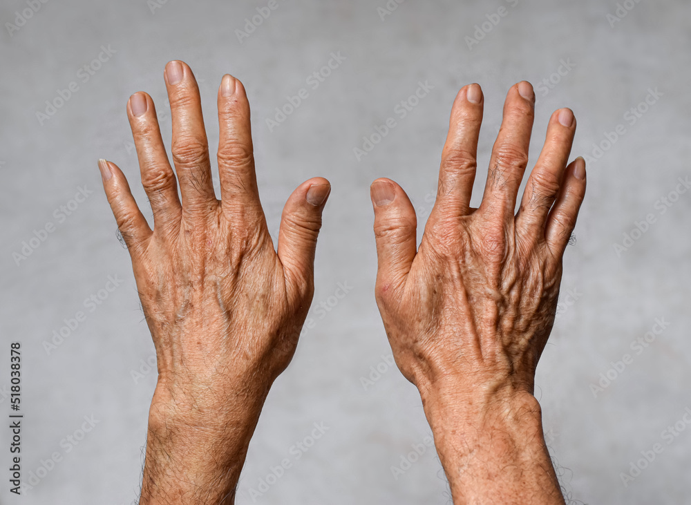 Age spots on hands of Asian man. They are brown, gray, or black spots ...