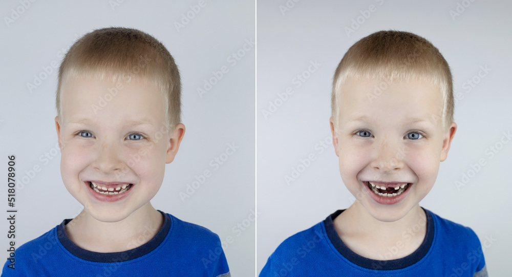 Before and after. Falling out milk tooth. Blond boy in photo has a ...