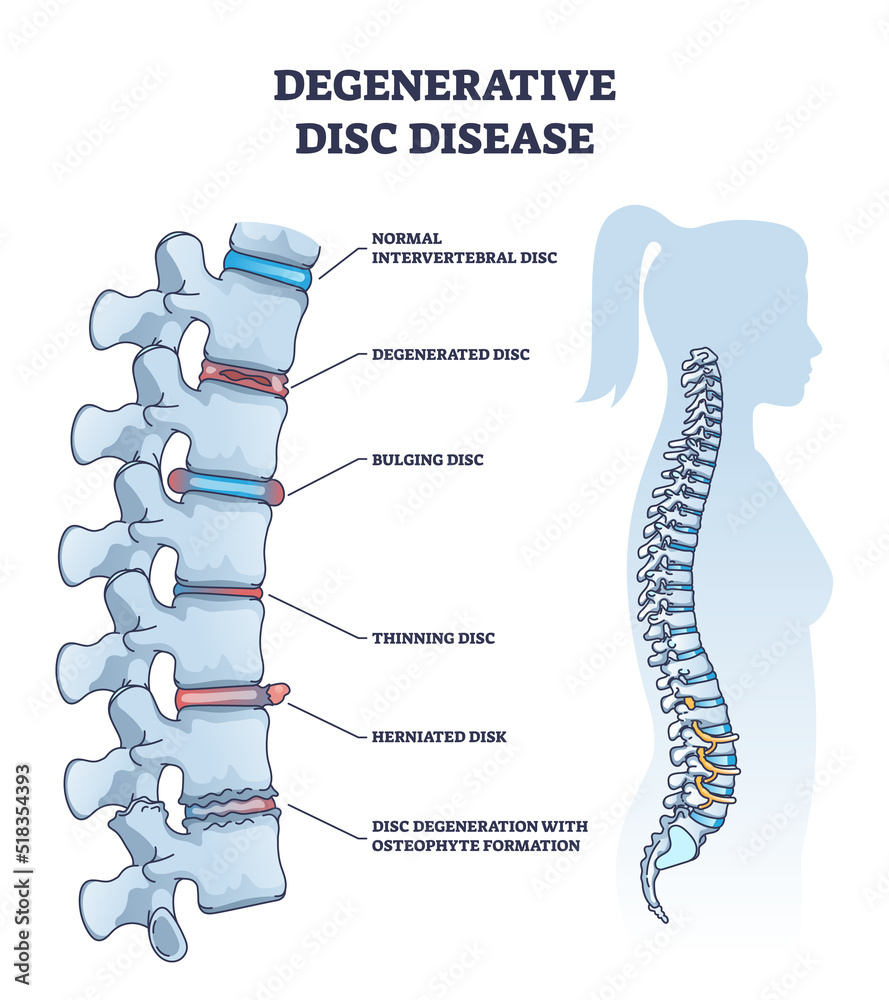Degenerative disc disease with spine and vertebra trauma outline ...