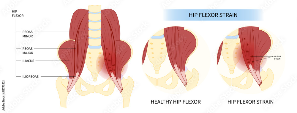 Muscle hip tendon Injury coxa saltans flexor stretch Pain rectus bursae ...