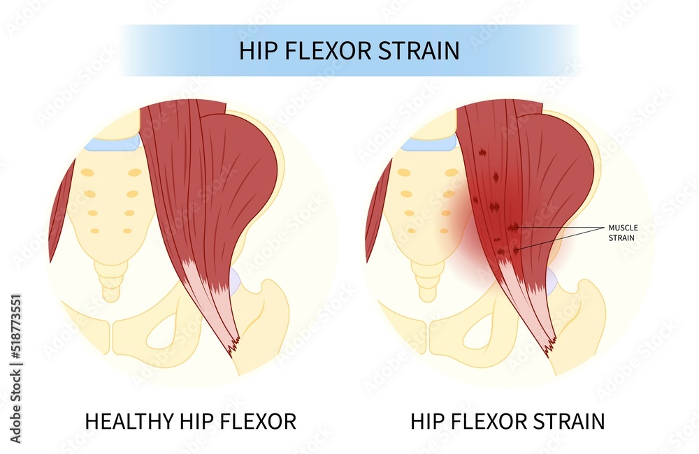 hip flexor stretch Pain of coxa saltans rectus bursae Intra groin ...
