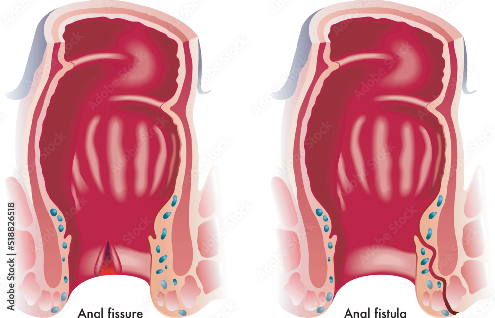 Medical illustration shows two common anal disorders, an anal fissure ...