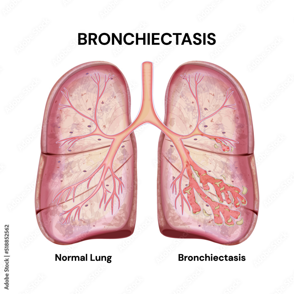 Lung disease. Bronchiectasis labeled diagram. Normal lung and ...