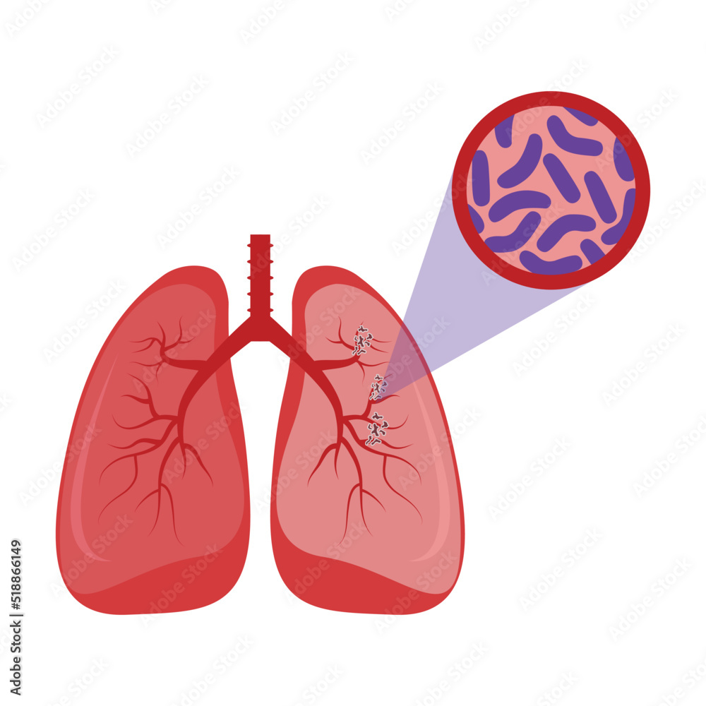 Vector de Stock Lungs of infected person. Mycobacterium tuberculosis ...