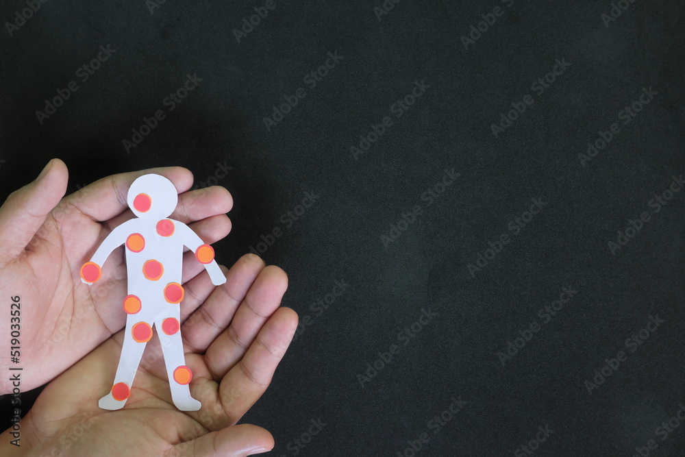 Photo Stock Pox disease such as monkeypox, smallpox and chicken pox ...