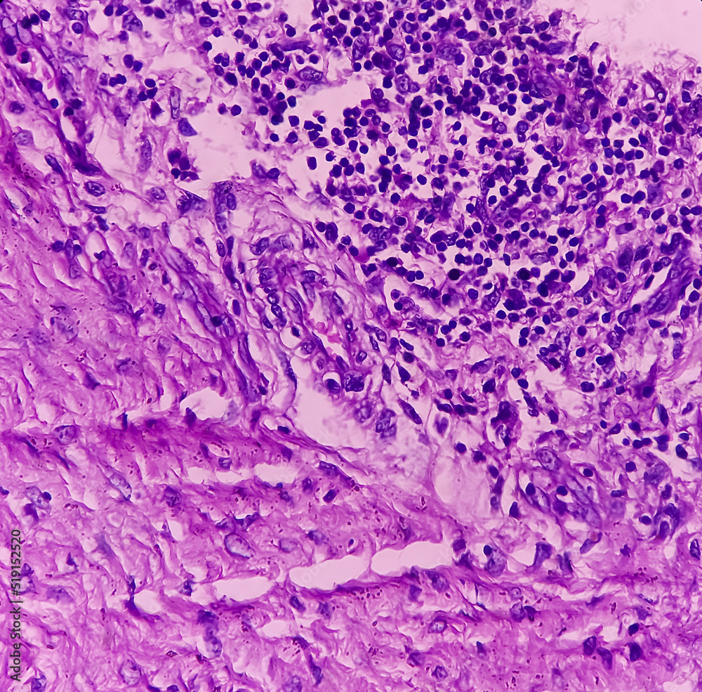 Microscopic image of neck mass cancer, Metastatic adenocarcinoma, show ...