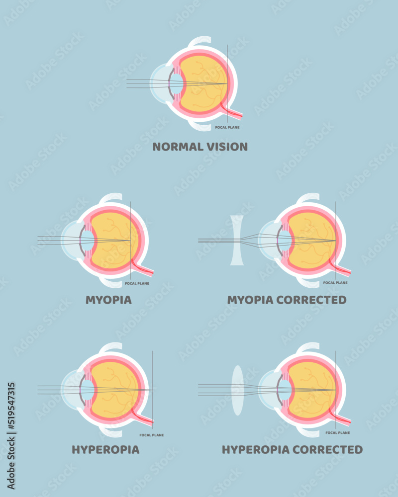 eyeball anatomy, internal organs body part nervous system, shortsighted ...