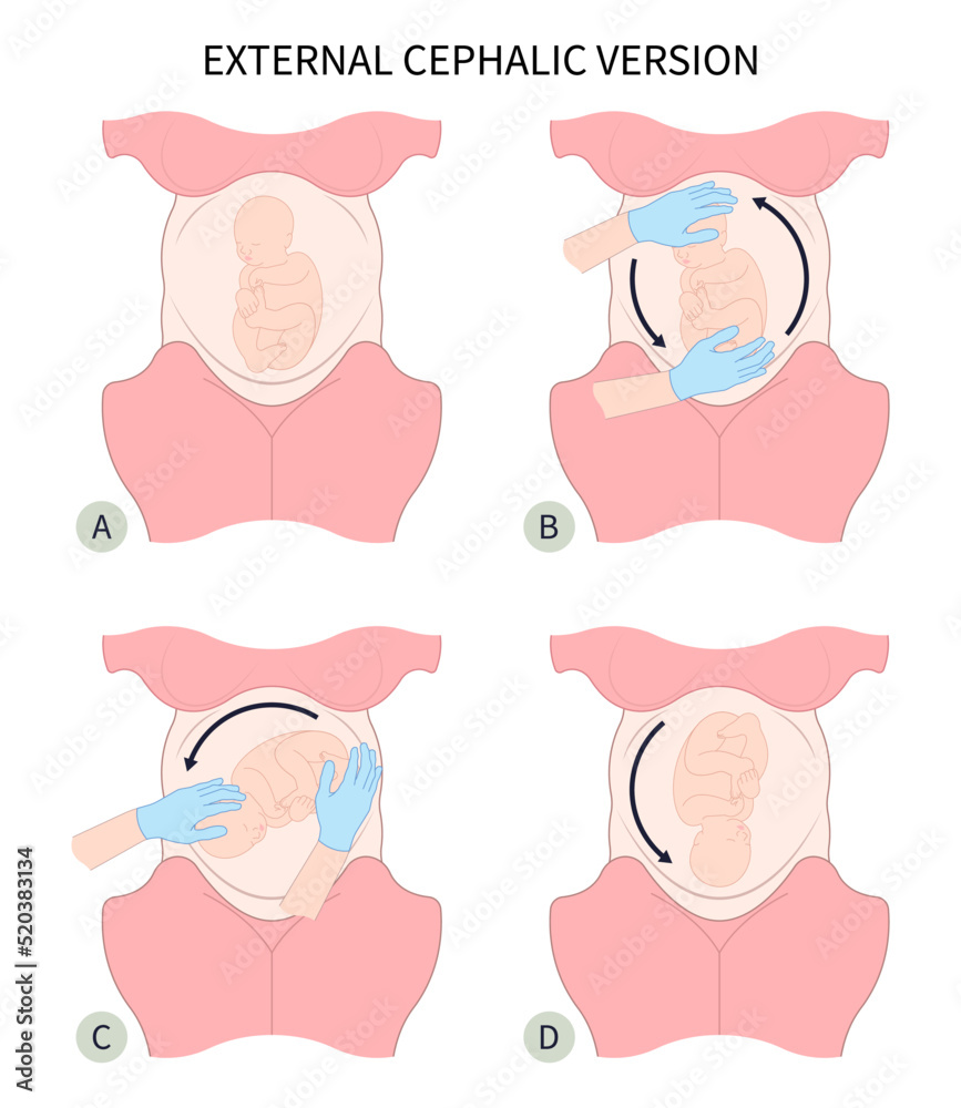 birth defect of Baby Labor C section praevia Mother twins cord hip lie ...
