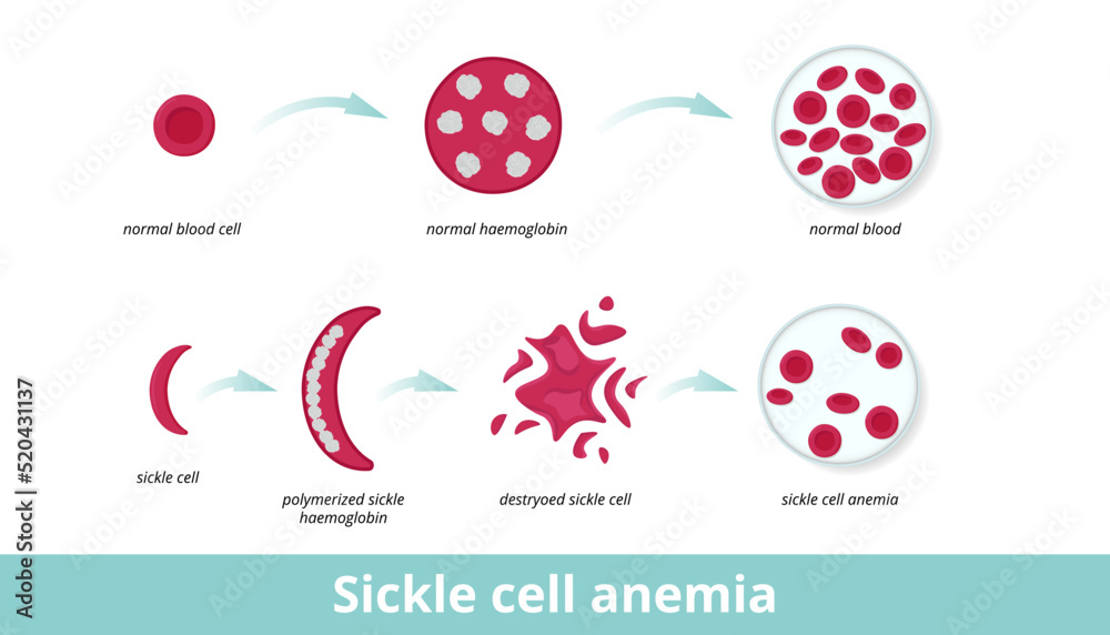 Sickle cell anemia. Sickle cell anemia (disease) occurs due to sticky ...