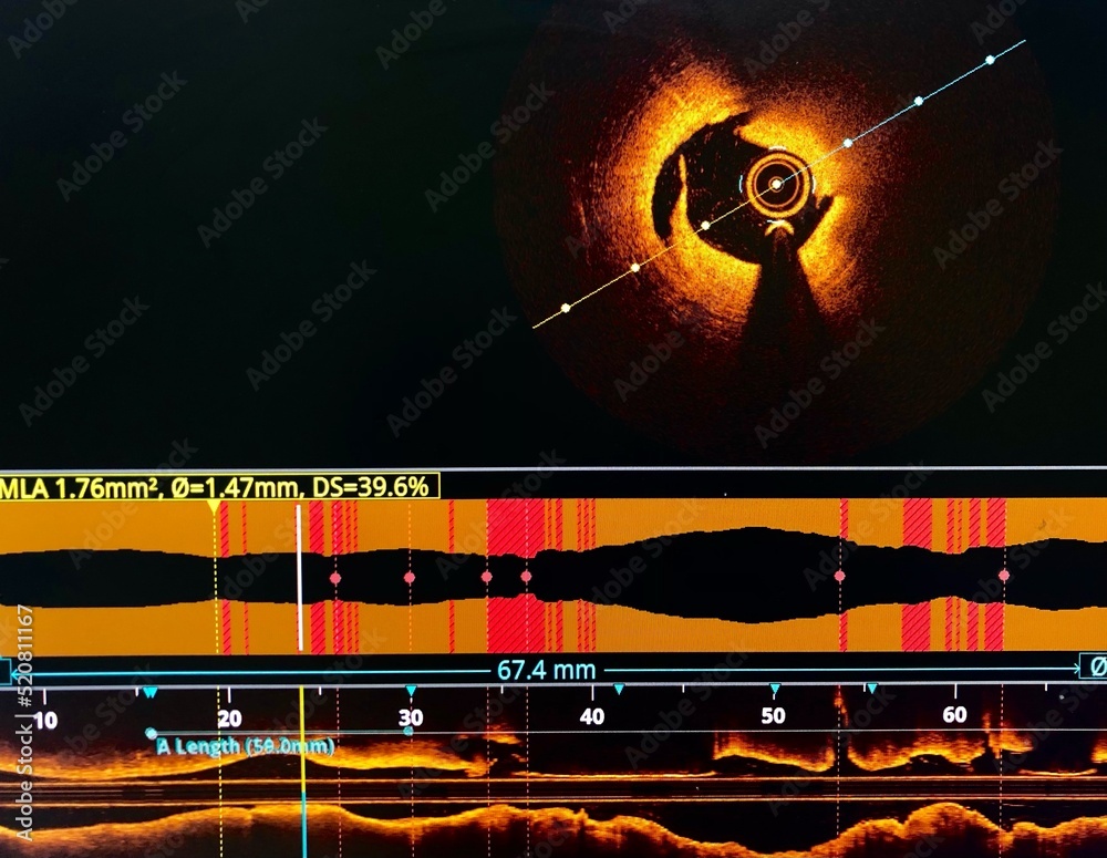 Intravascular imaging Optical Coherence Tomography (OCT) shown ...