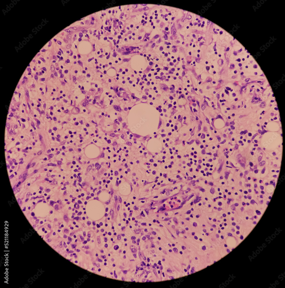 Granulomatous inflammation with tuberculosis. Microscopic show ...