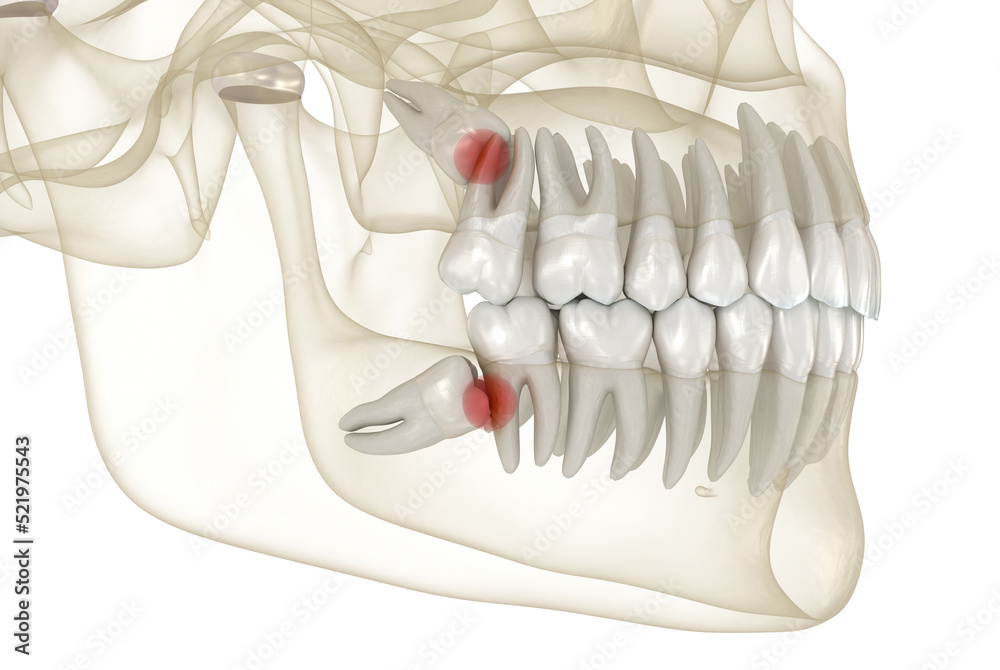 Mesial impaction of Wisdom teeth to the second molar. Medically ...