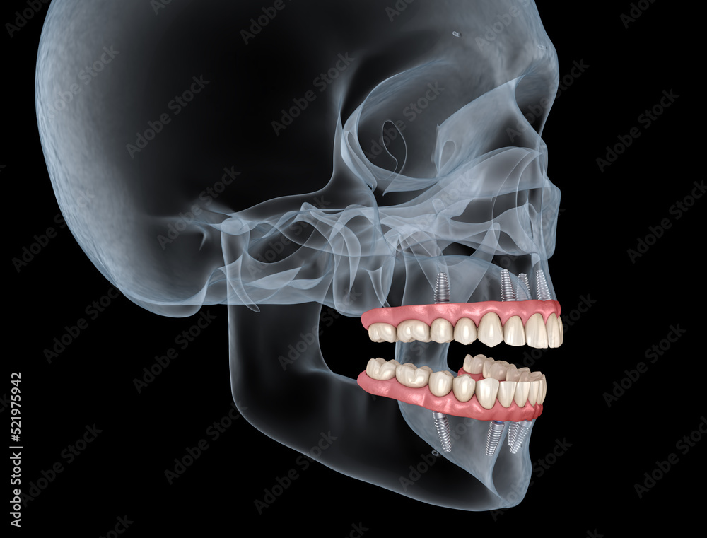 Maxillary and Mandibular prosthesis with gum All on 4 system supported ...