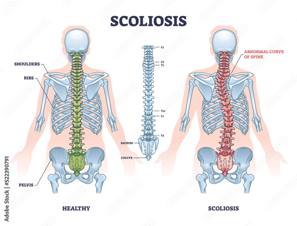 เวกเตอร์ Stock Scoliosis as medical sideways curvature illness of spine ...