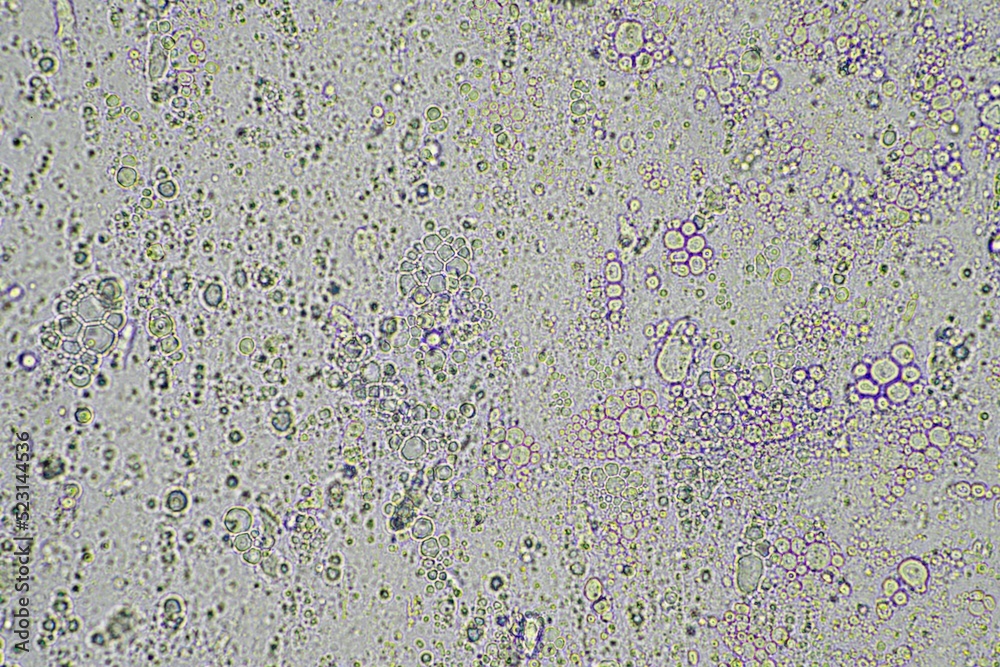 Coughing up mucus and phlegm from a chest infection from a virus and ...